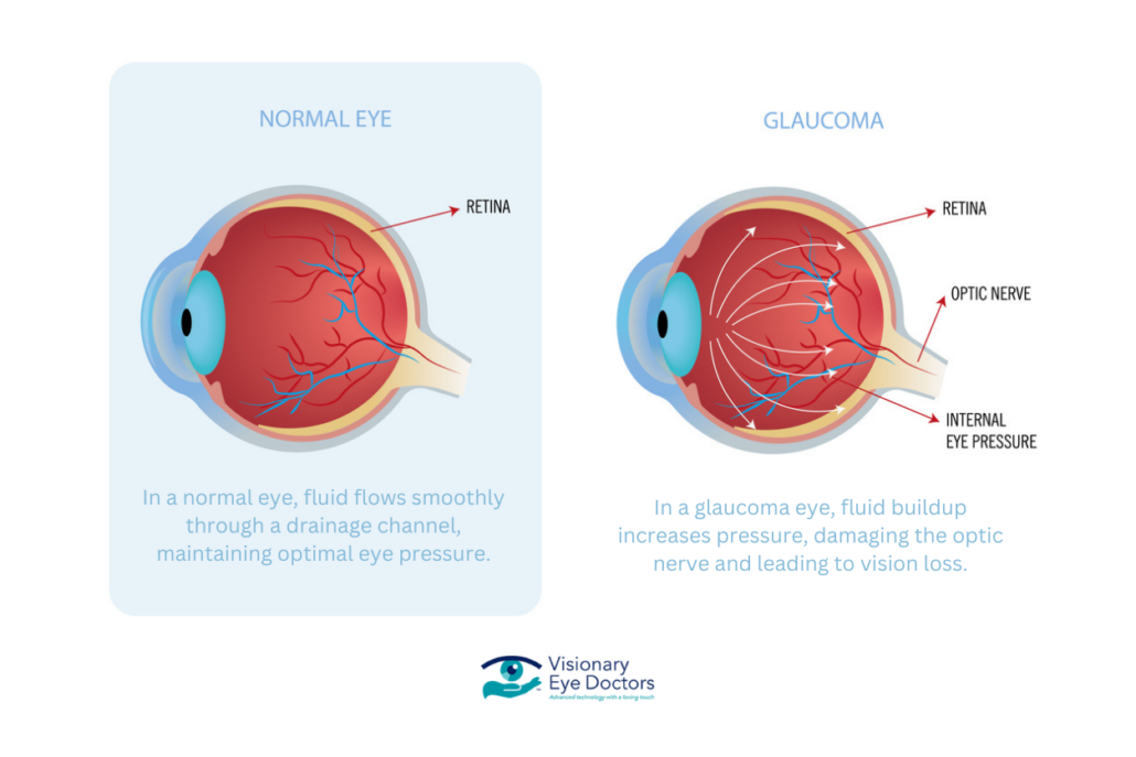 What is Usually the First Sign of Glaucoma? | Comprehensive Guide