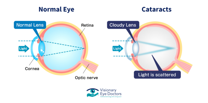Can Cataracts Increase the Pressure in Your Eye? Causes and Treatments