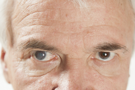 Can Cataracts Increase the Pressure in Your Eye? Causes and Treatments