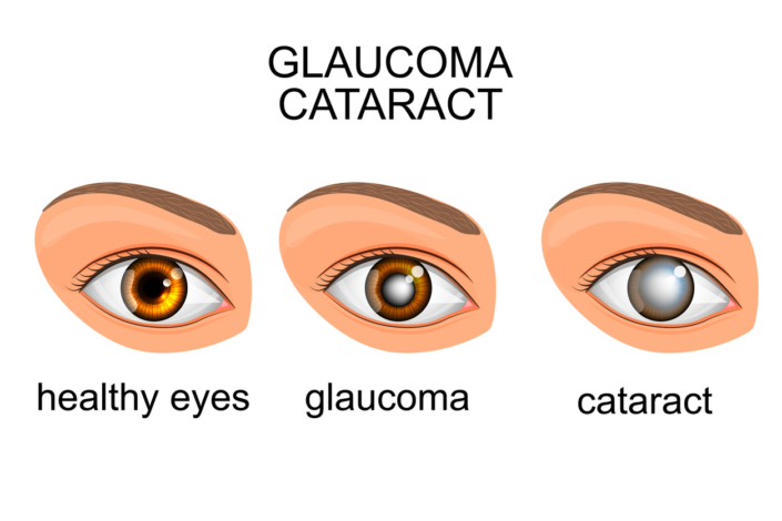 Cataracts vs. Glaucoma: Key Differences & Treatment Options