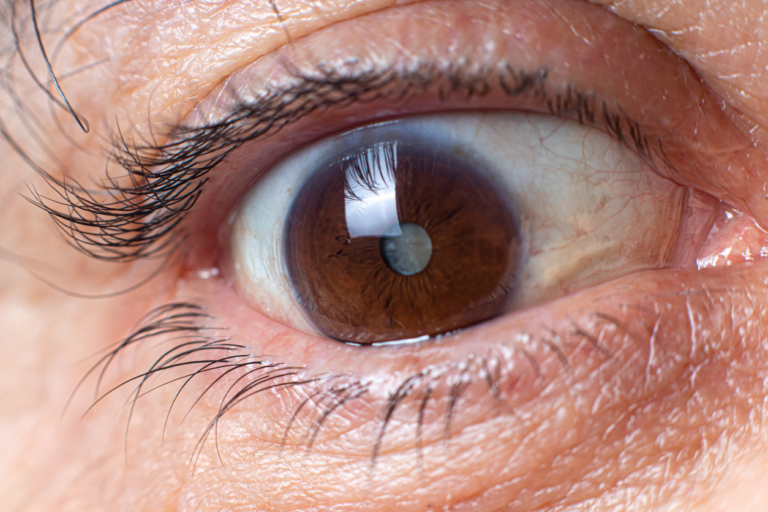 Contact Lenses After Cataract Surgery: What to Know