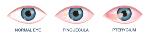 How Pinguecula Removal Improves Eye Appearance & Comfort