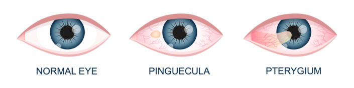 How Pinguecula Removal Improves Eye Appearance & Comfort