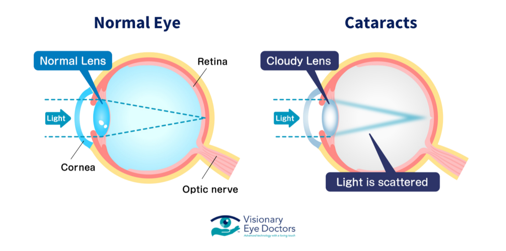 Signs and Symptoms of Cataracts | Causes & Treatments