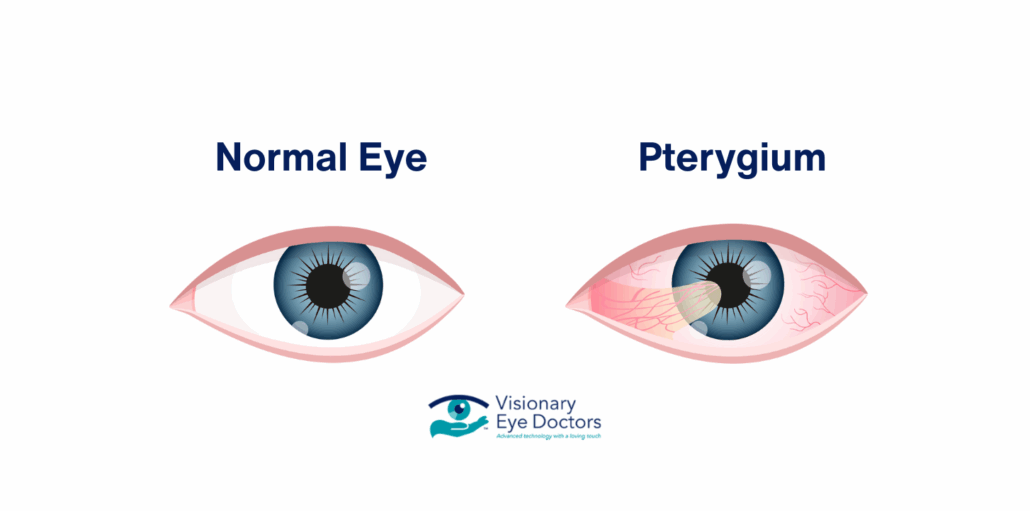 Is Pterygium Surgery Right For You? Treatment Options