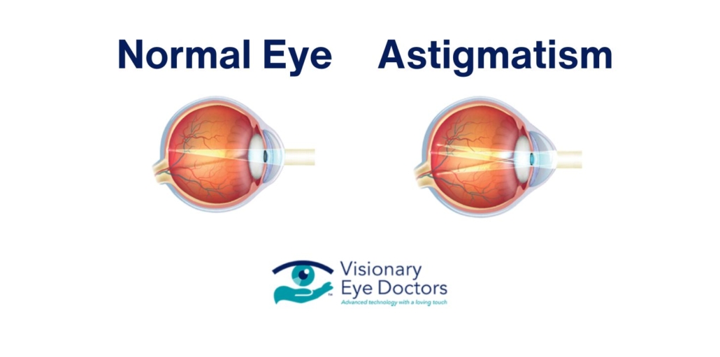 Can Astigmatism Be Corrected? Treatment Options | Visionary Eye