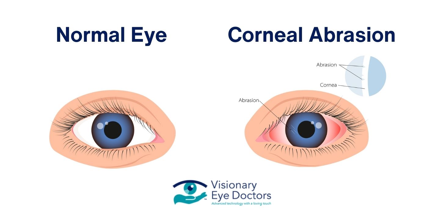 How Can You Tell if You Scratched Your Cornea? | Visionary